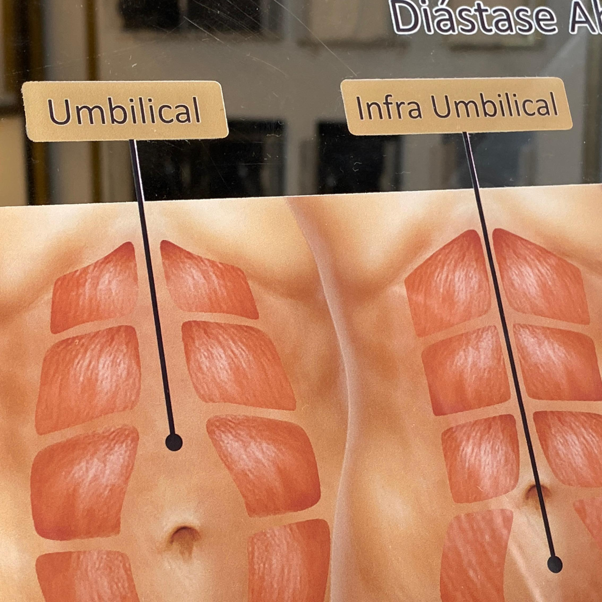 Diástase Abdominal - Quadro de Marcação - Macromodelo - Guia Estético - M