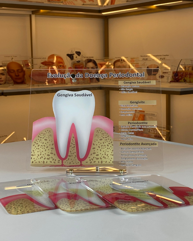 Estagios Da Doenca Periodontal O Que Seria A Periodontia E A Doença